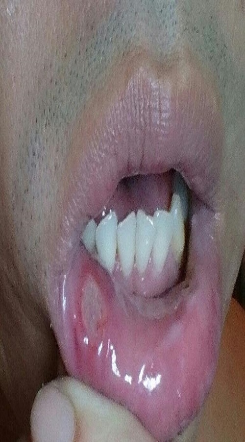 Some reasons of Ulcers